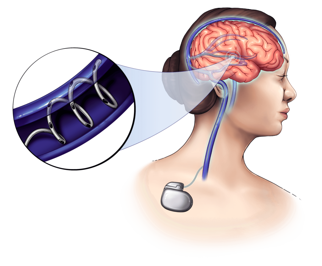 NeuroBionics | Revolutionizing Neurotechnology & Interfaces